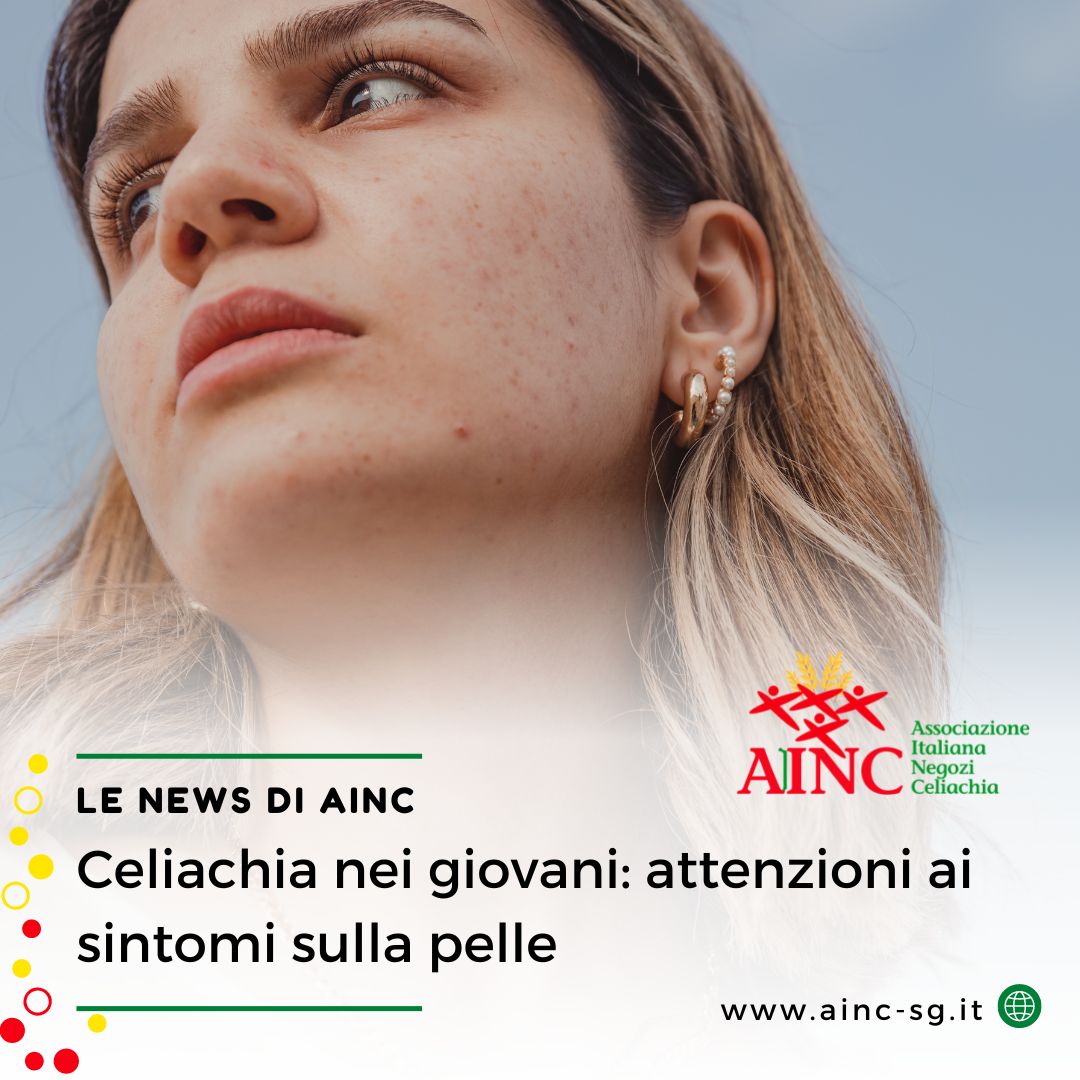 Celiachia nei giovani: attenzione ai segni sulla pelle - AINC